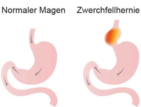 Zwerchfellbruch | Reflux: Diagnostik und Behandlung